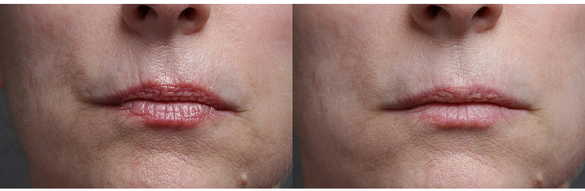 Upper lip lines aka smoker’s lines, lipstick lines, or perioral ...